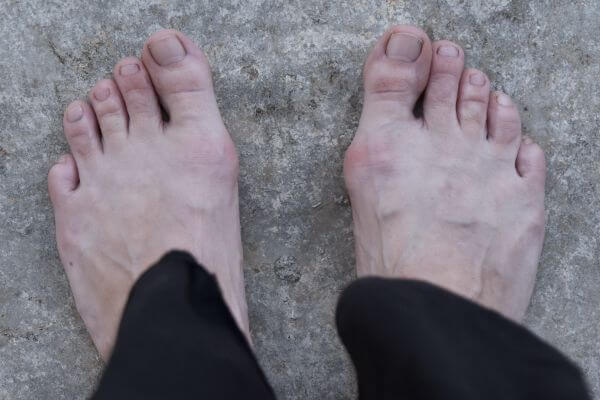 Hallux valgus = Ballenzeh | Footic.de